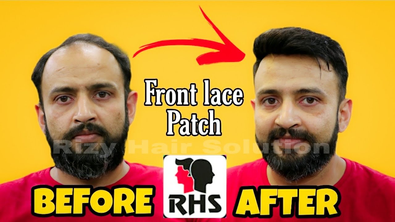 Front Lace Hair Patch | Hair Patch For Men | Hair Wig For Men ...