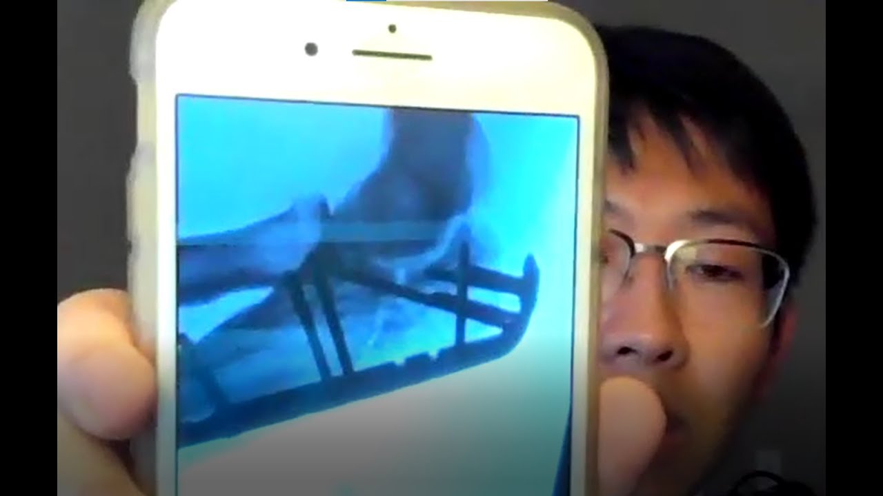 ORIF (Open reduction internal fixation) post-surgery recovery, day 1 ...