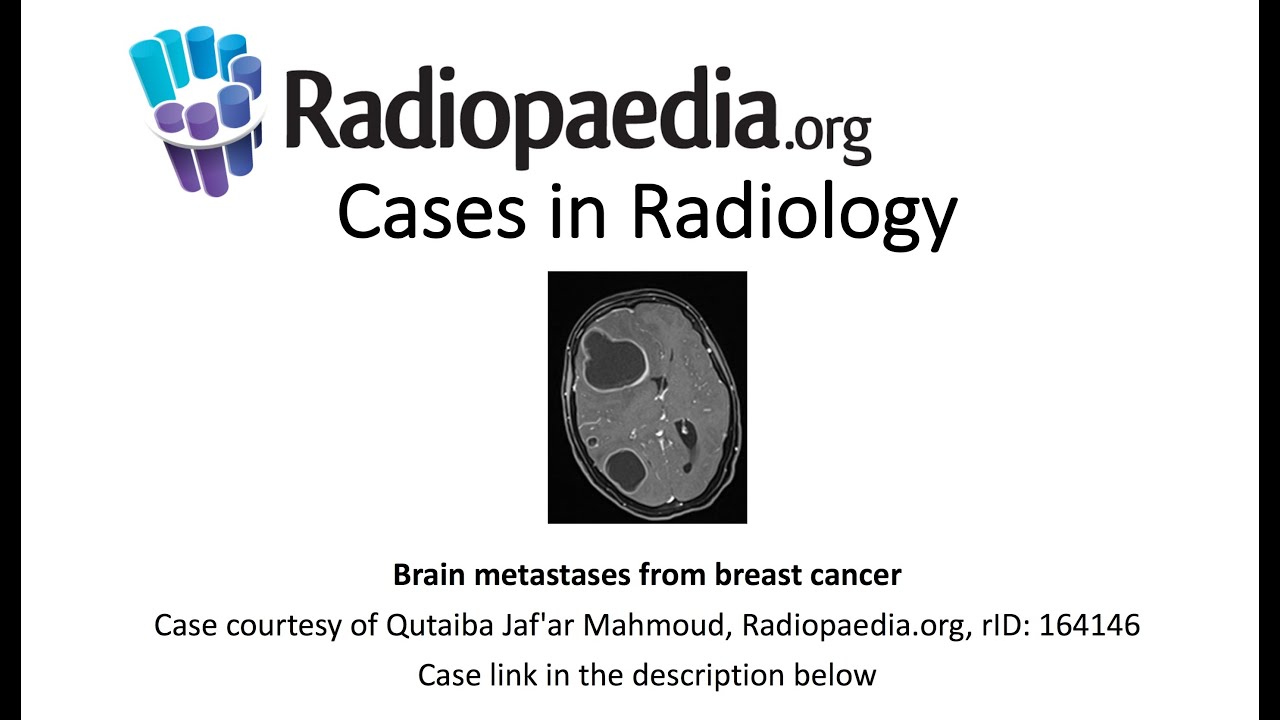 Brain metastases from breast cancer (Radiopaedia.org) Cases in ...
