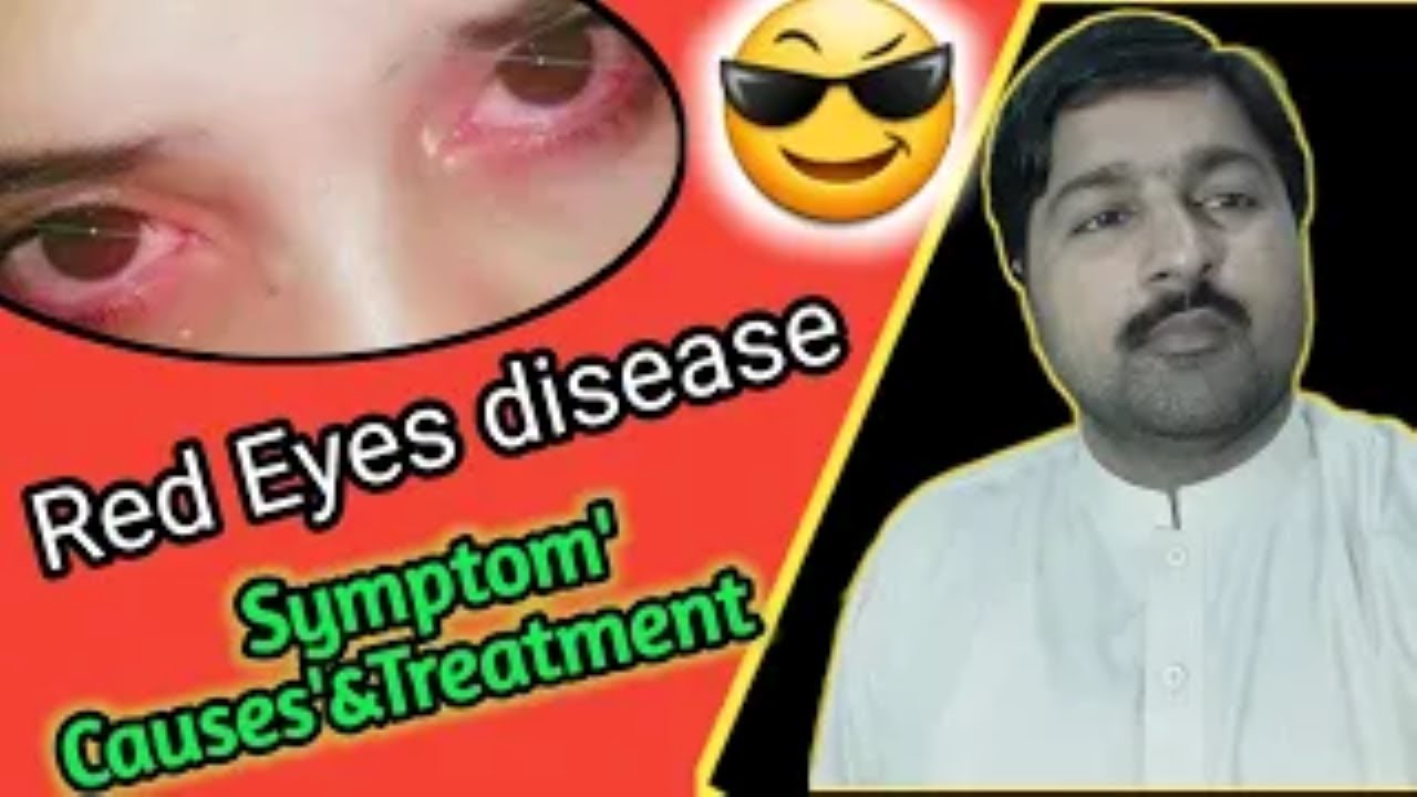 Red Eye disease | Red eye disease in Hindi | red eye disease home ...