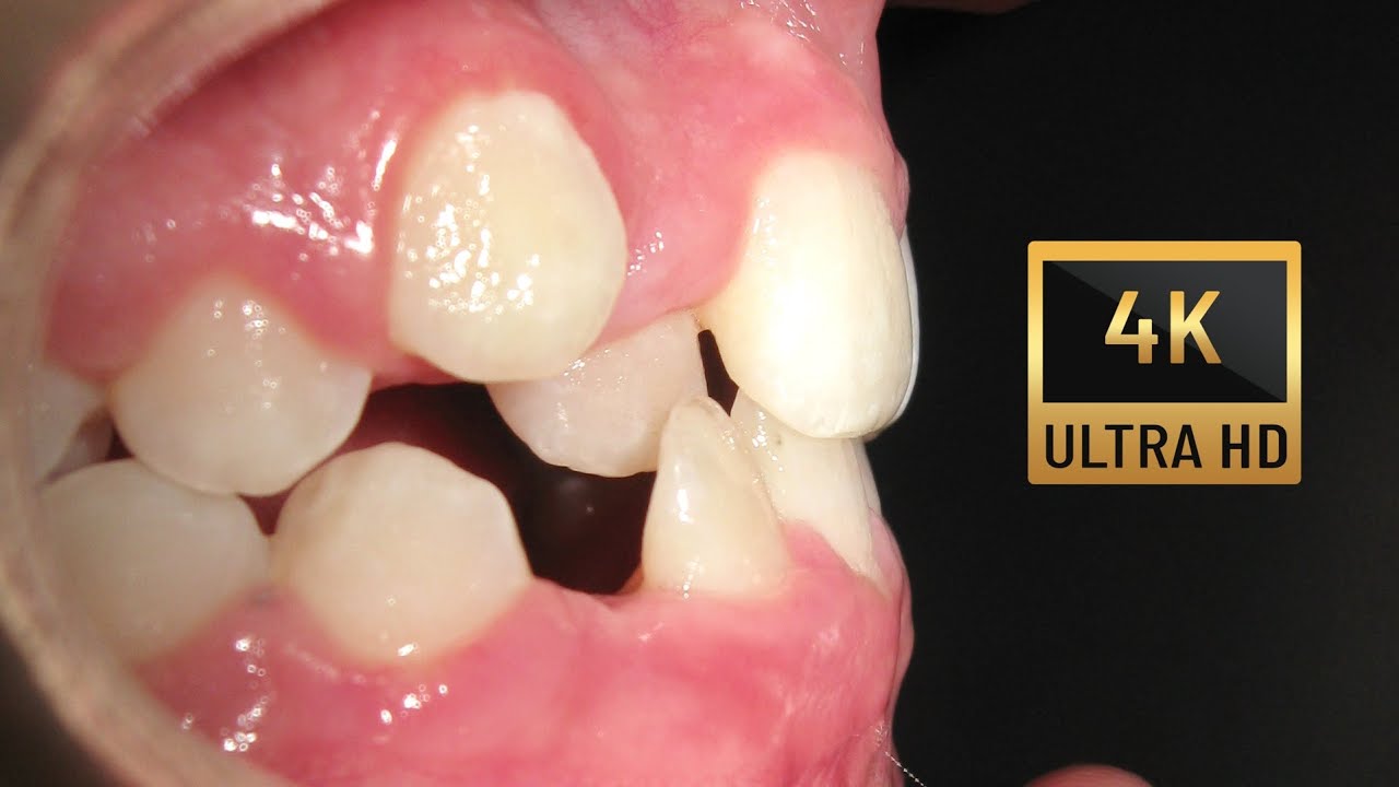 Class III and Crossbite stability after 8 years! Braces time lapse ...