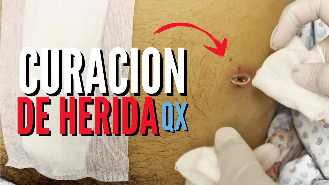 🔴DEMOSTRACIÓN | ¿Como HACER una CURACION DE HERIDA QUIRURGICA ...