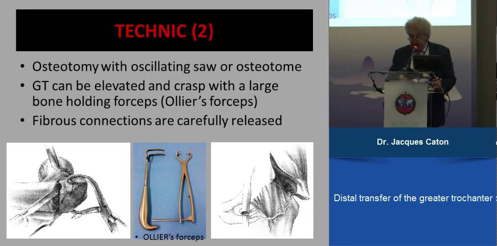 DISTAL TRANSFER OF THE GREAT TROCHANTER - YouTube