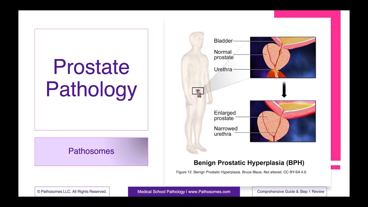 Prostate Pathology | Comprehensive Guide & Step 1 Review | Pathology ...