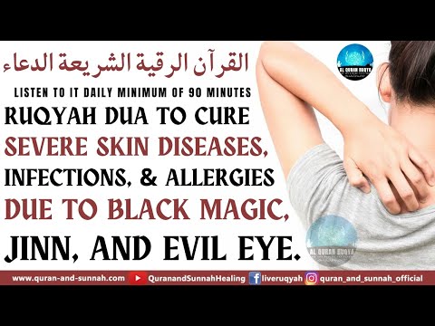 Ruqyah To Cure Severe Skin Diseases, Infections, & Allergies Due To Black Magic, Jinn, And Evil Eye.