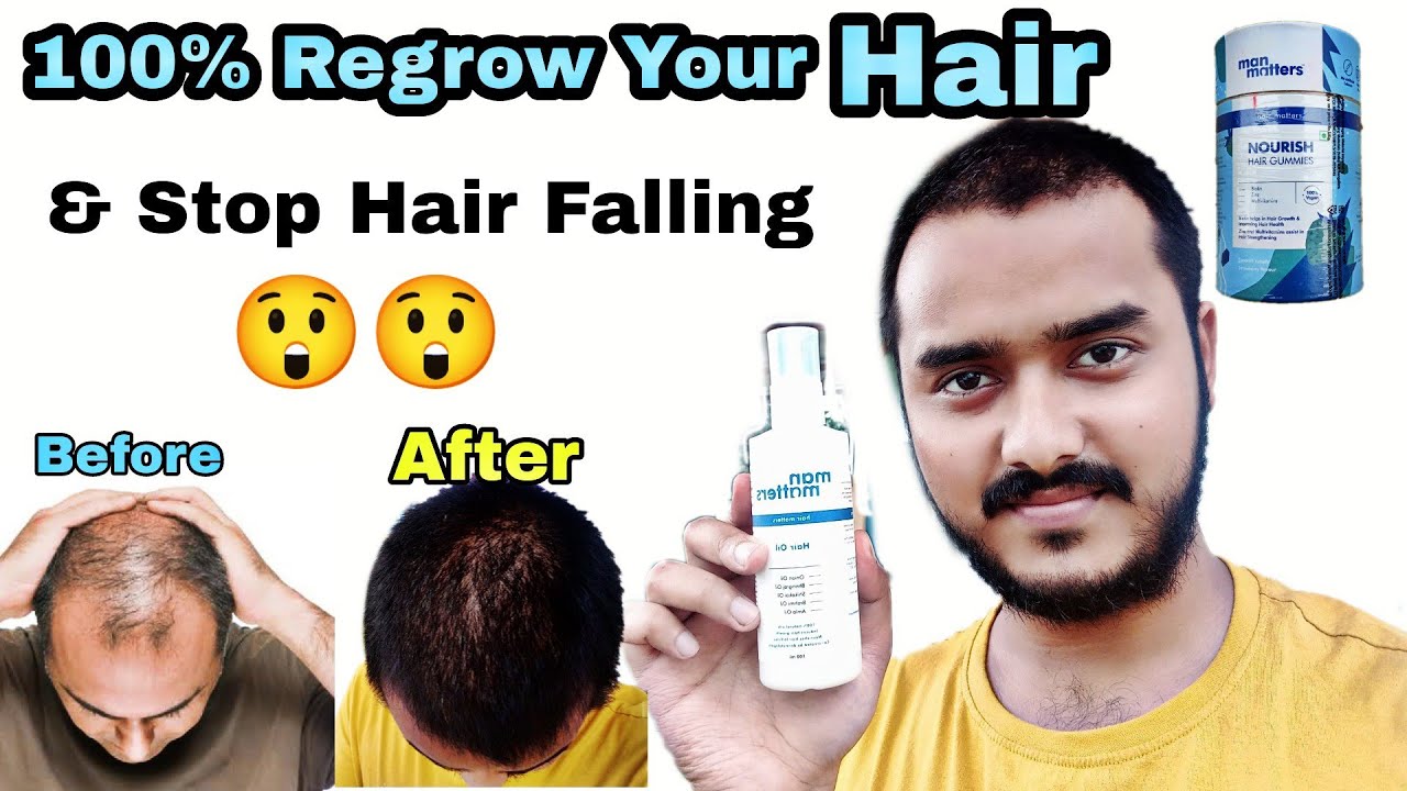 How To 100% Regrow Your Fallen Hair😲? - YouTube