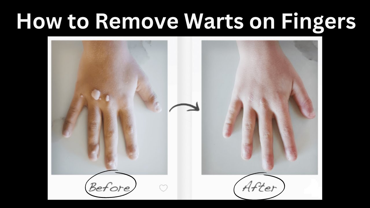How to remove warts on fingers naturally - Reviews - YouTube