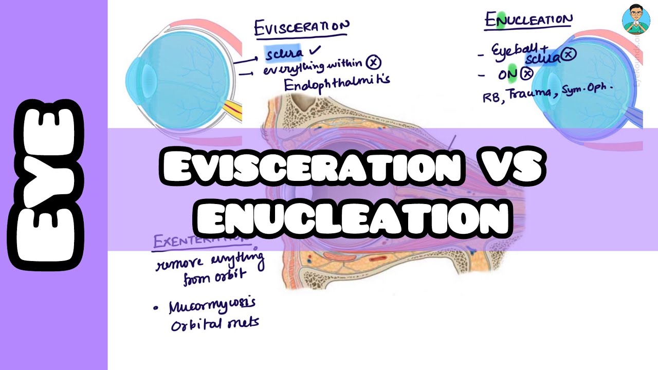Evisceration VS Enucleation: eye removal surgery for #inicet #usmle # ...