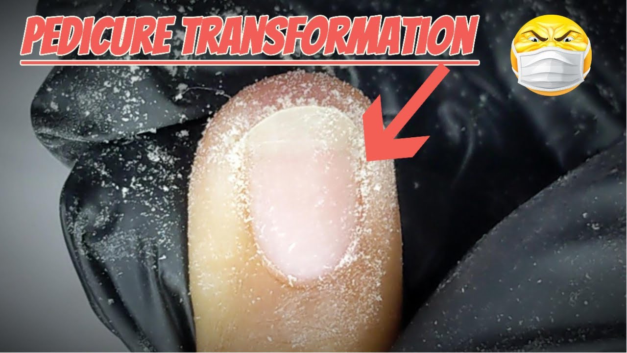 "Amazing Pedicure Transformation: Step-by-Step Process for Perfect ...