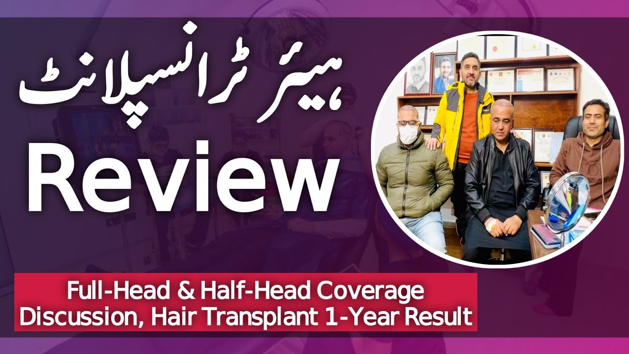 SHOCKING 1 YEAR HAIR GROWTH! Full Head Transplant Transformation ...