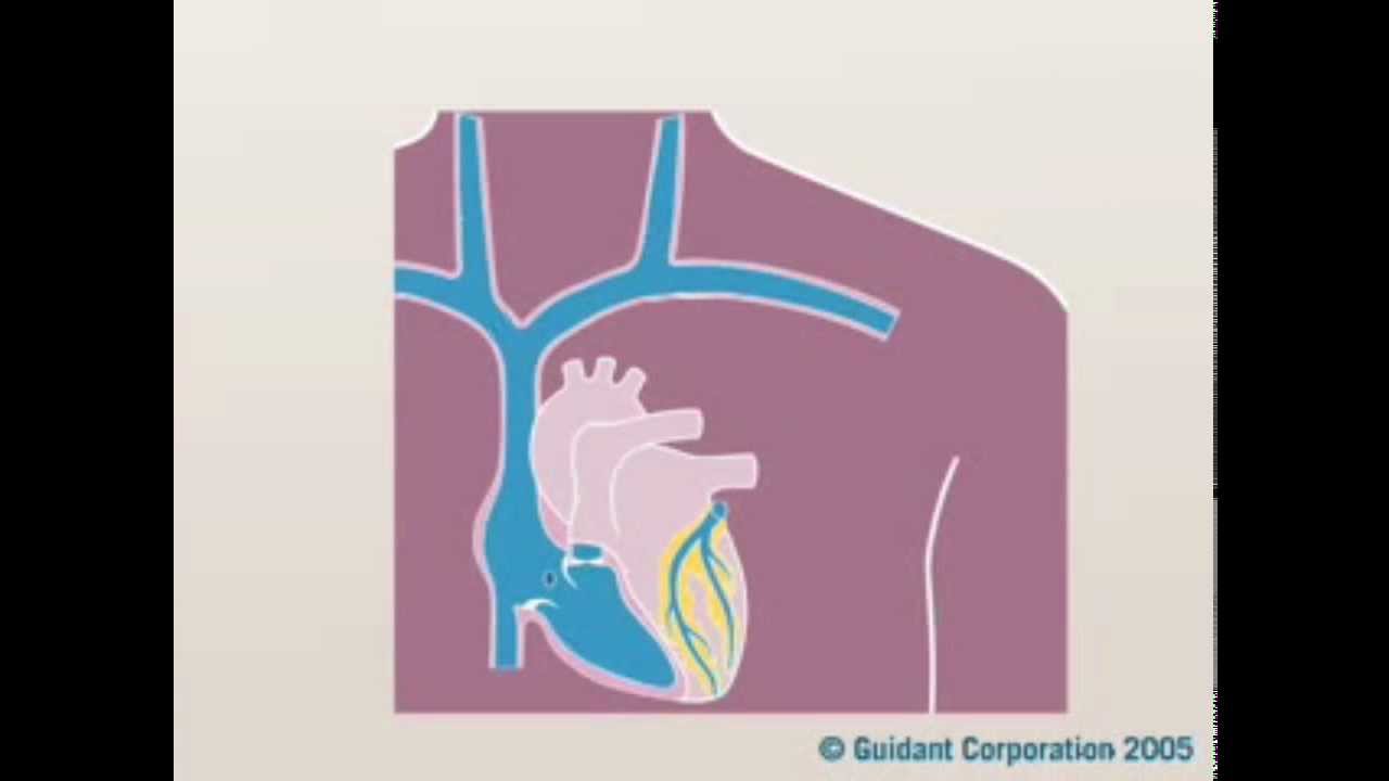 Animated Placement of Permanent Pacemaker - YouTube