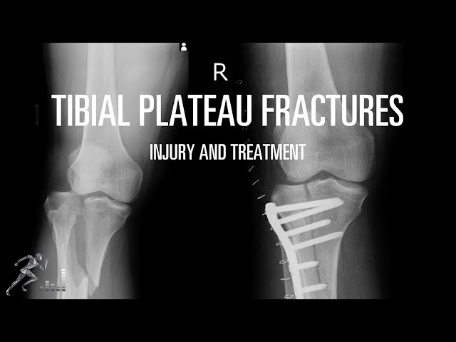 Tibial Plateau Fracture Xray