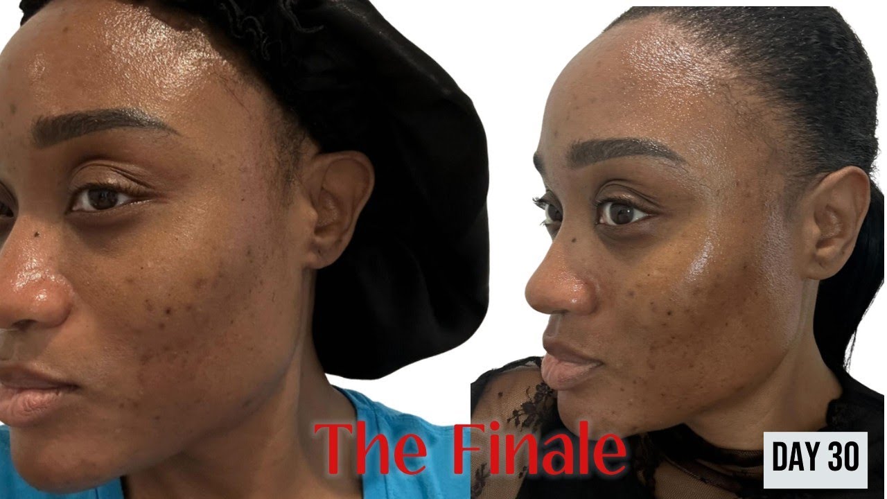 I Tried Beef Tallow Skincare for Hyperpigmentation for 30 Days - YouTube