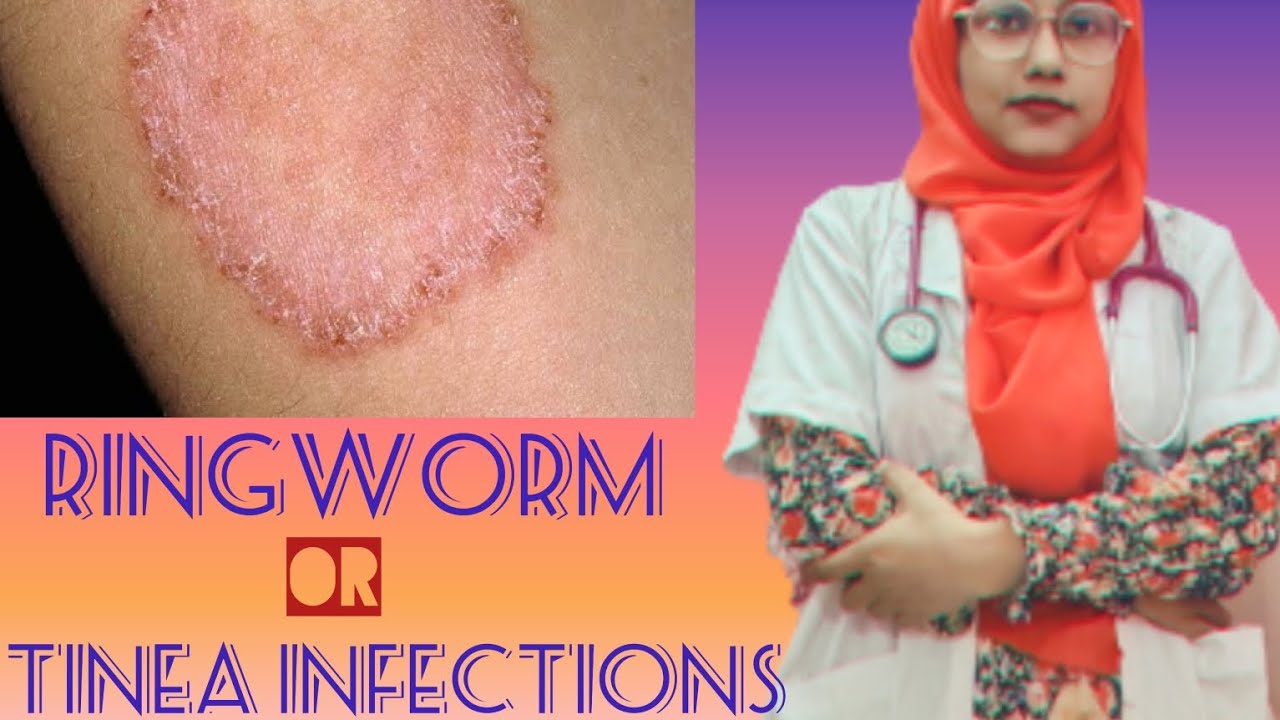Ringworm?Sings & Symptoms of Tinea Infections.#ringworm #tinea # ...