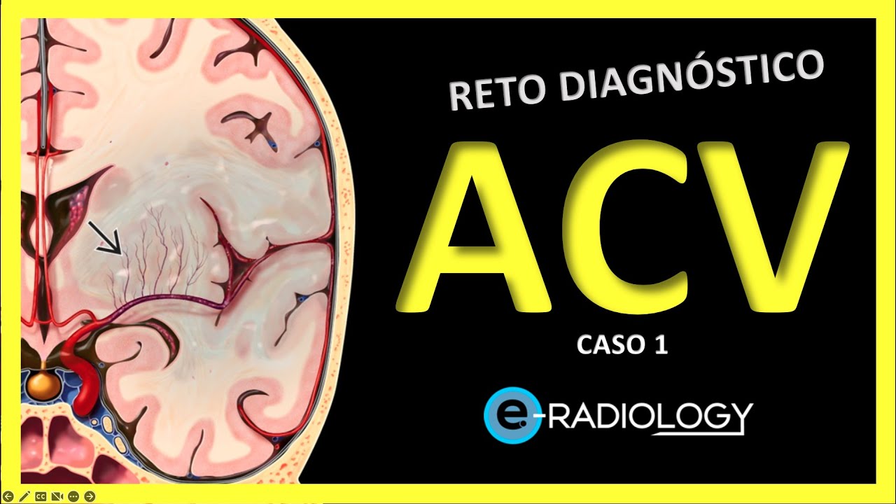 ECV 🧠 - Caso 1 | Enfermedad CEREBROVASCULAR | Explicación de SIGNOS ...