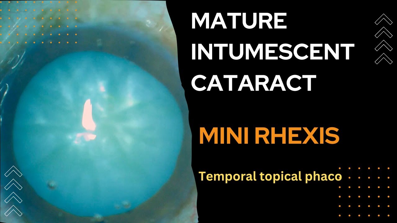 Case series 67. Mature Intumescent Cataract, mini Rhexis, temporal ...