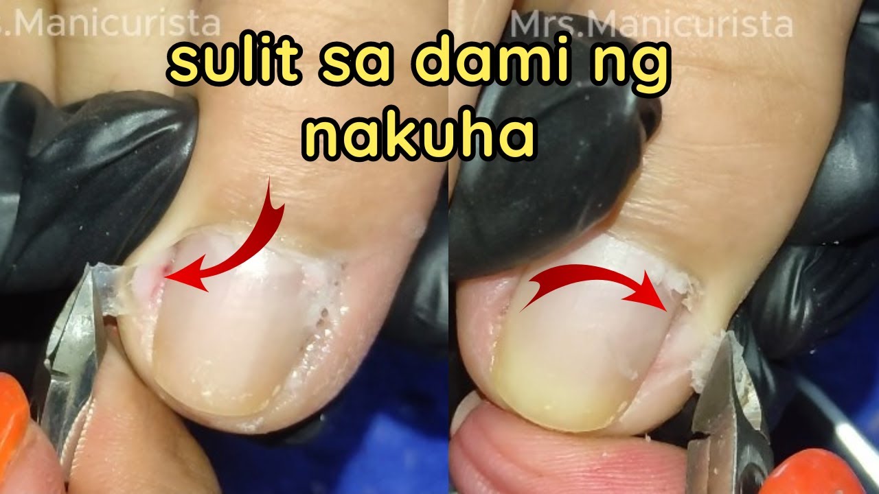 Vlog 1063|Dry Skin/Ingrown Removal| PEDICURE 963 - YouTube