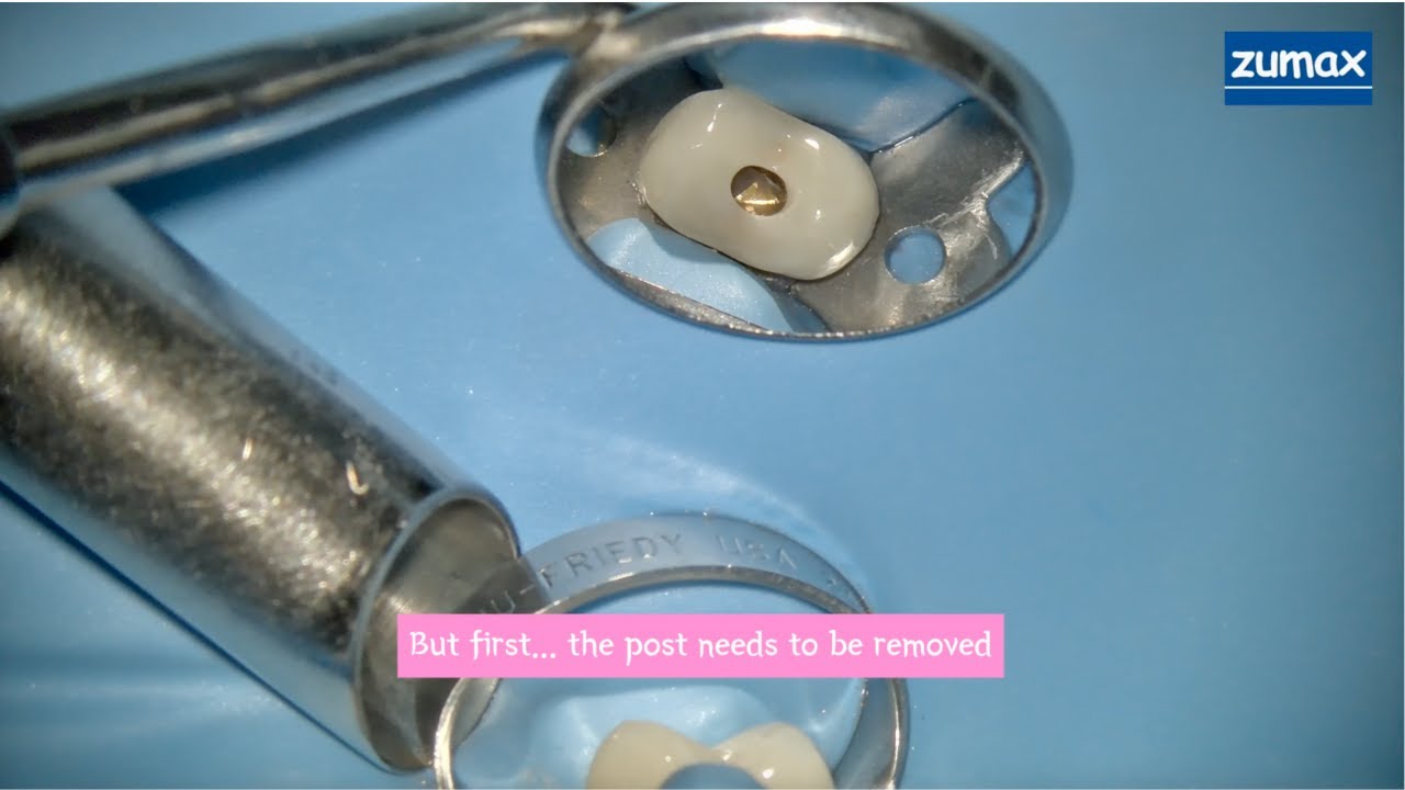 What Happens During a Root Canal Appointment | Metal Post Removal - YouTube