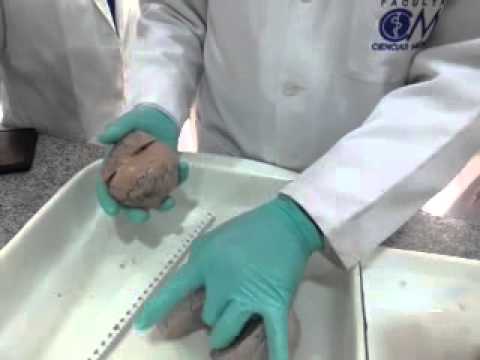 Teratoma quistico monodermal y Fibrotecoma - YouTube