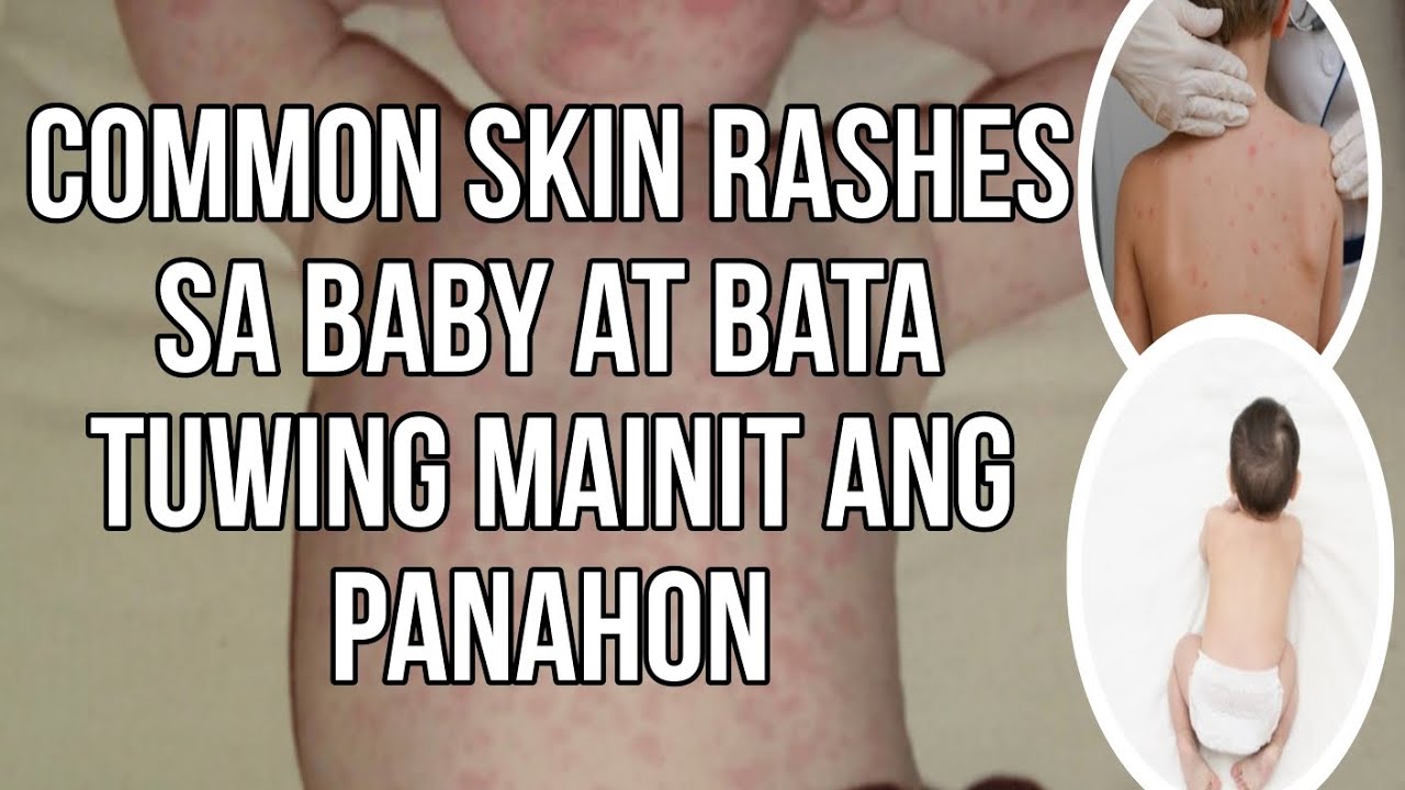 IBA'T-IBANG URI NG SKIN RASHES NI BABY | Dahilan at Lunas ating ALAMIN ...