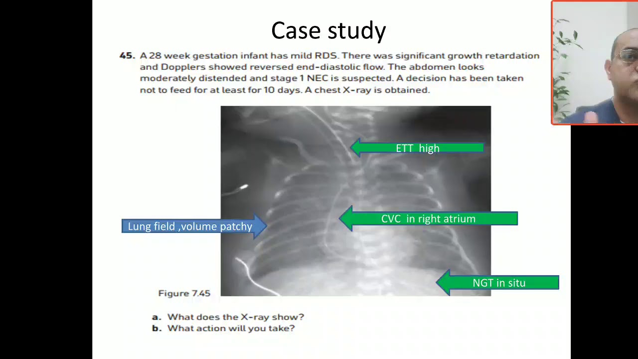Case 124 complications central venous catheter for IUGR infant, NEC ...