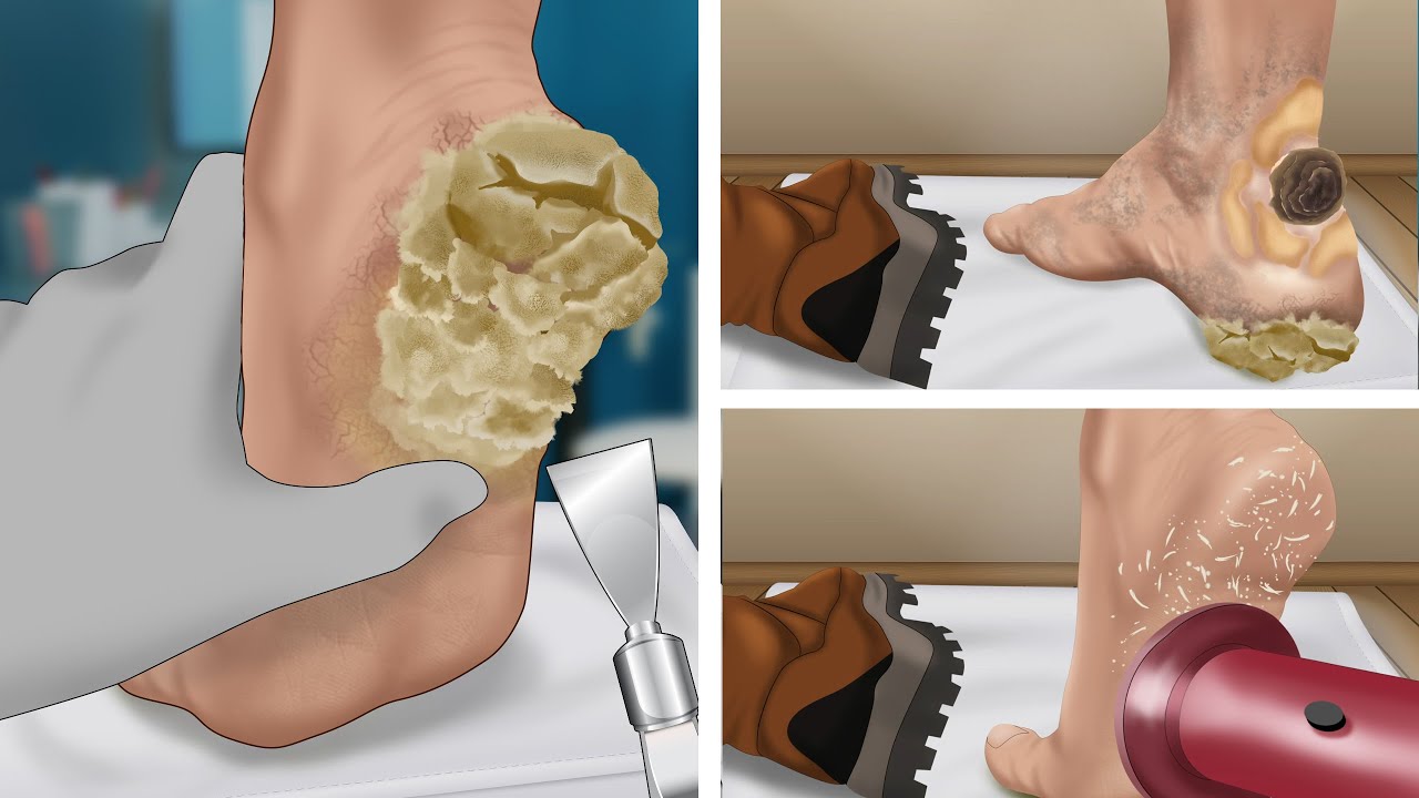 ASMR Remove Large Plantar Warts, Calluses | Foot wart treatment - YouTube