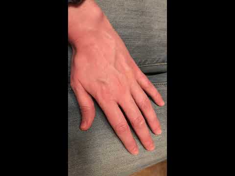 Blood Pooling in Hand - YouTube