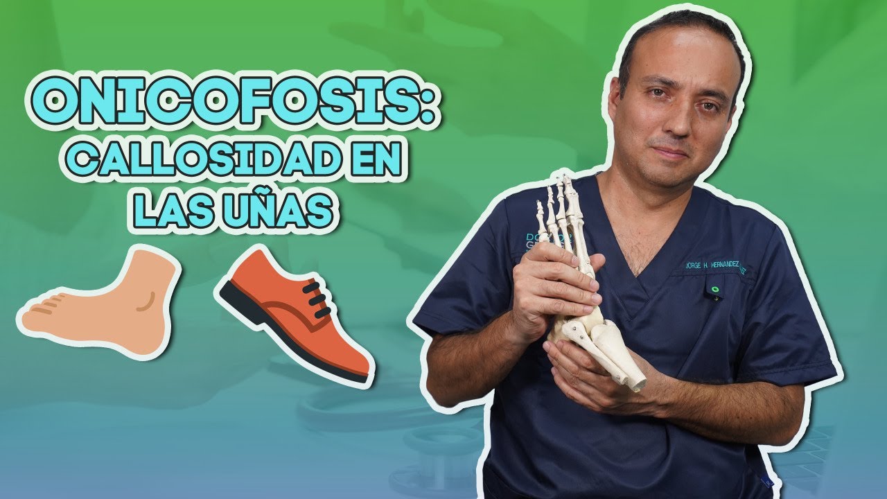 ¿Qué es la onicofosis? - YouTube
