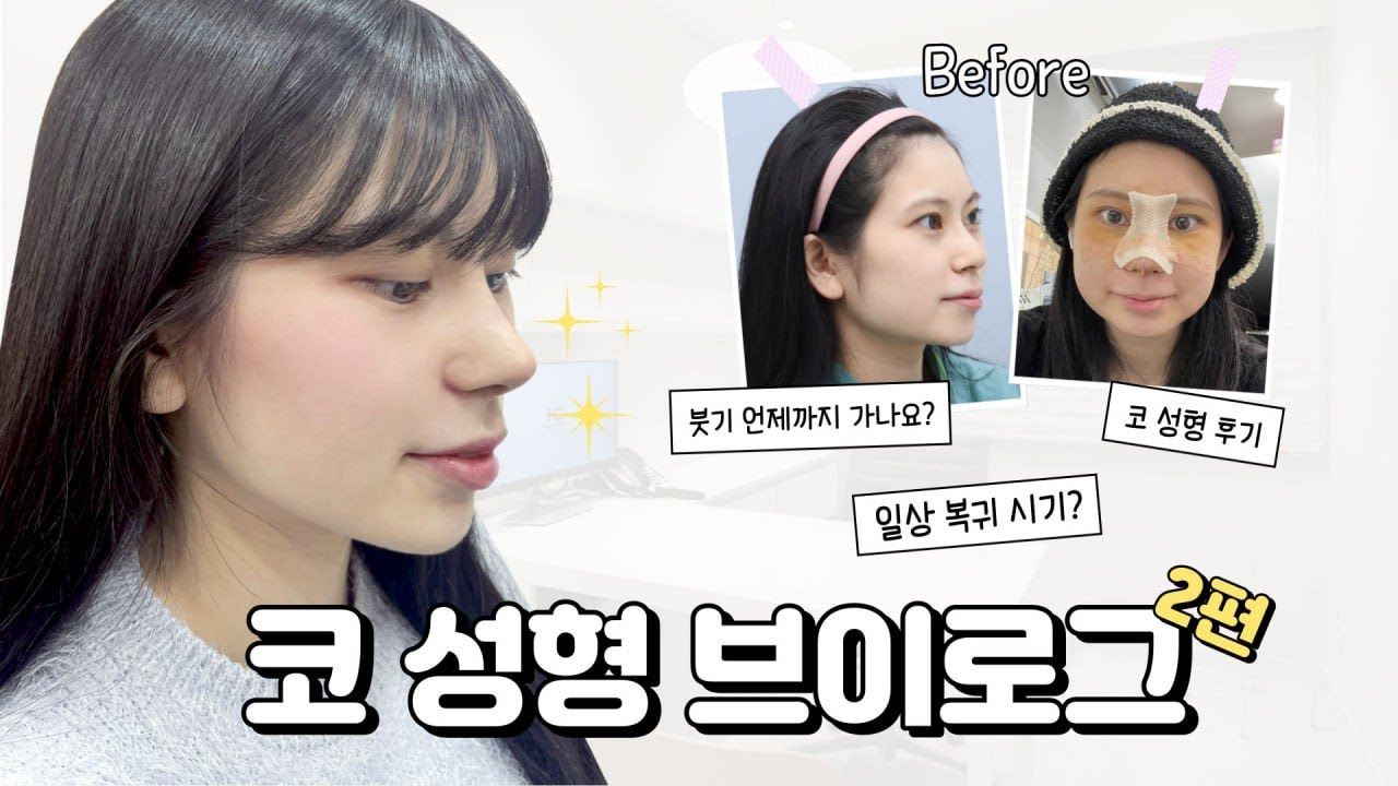 코성형브이로그 일본인 성형 Vlog 2탄 성형브이로그 한 달 경과 직장인 코수술 리얼후기 복코 실밥and부목제거 수술 후 일상생활까지 콧볼축소