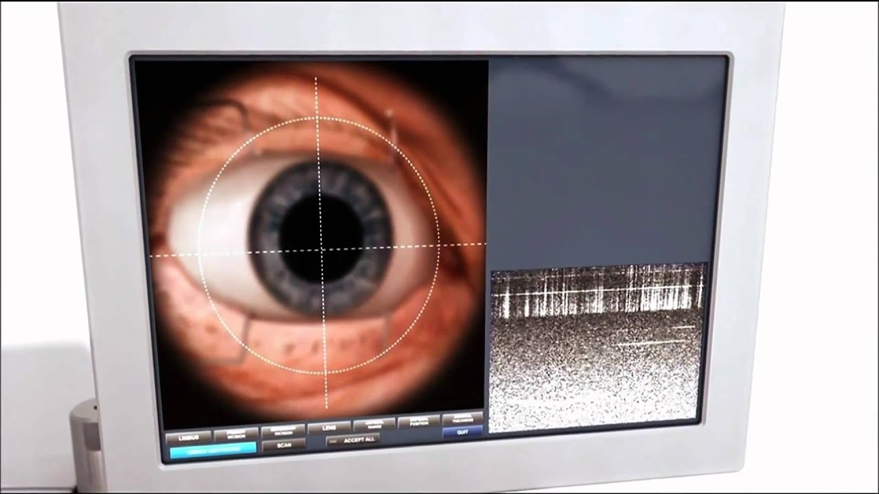 Stephen Slade MD Laser Cataract Surgery NEW Animation - YouTube