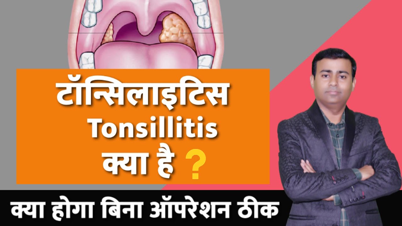 Tonsillitis kya hai क्या होगा बिना ऑपरेशन ठीक #tonsillitis #tonsil # ...