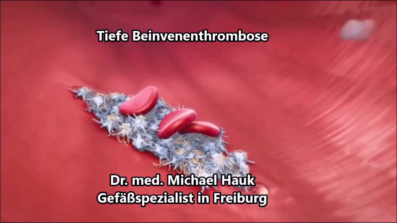 Tiefe Beinvenenthrombose - YouTube