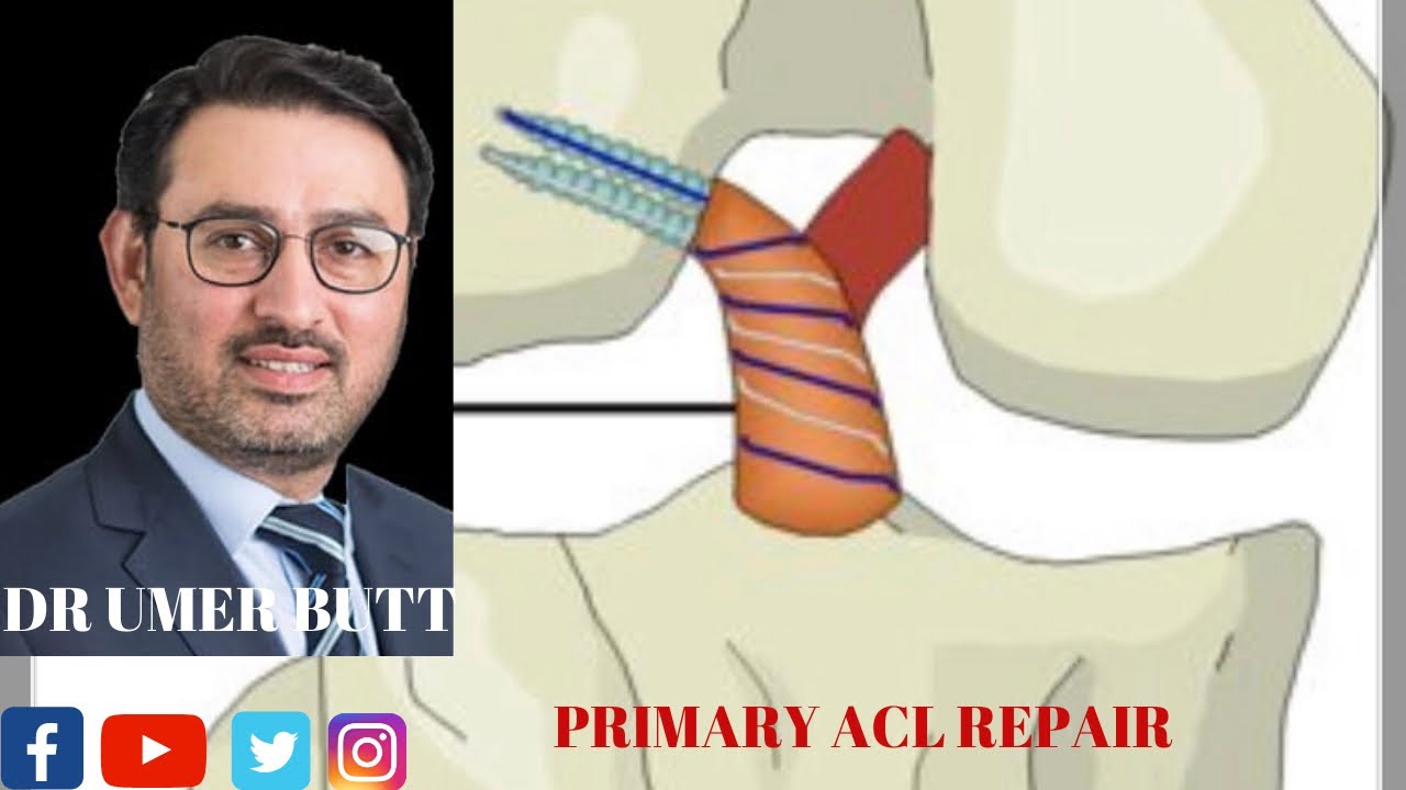 PRIMARY ACL REPAIR BY DR UMER BUTT - YouTube