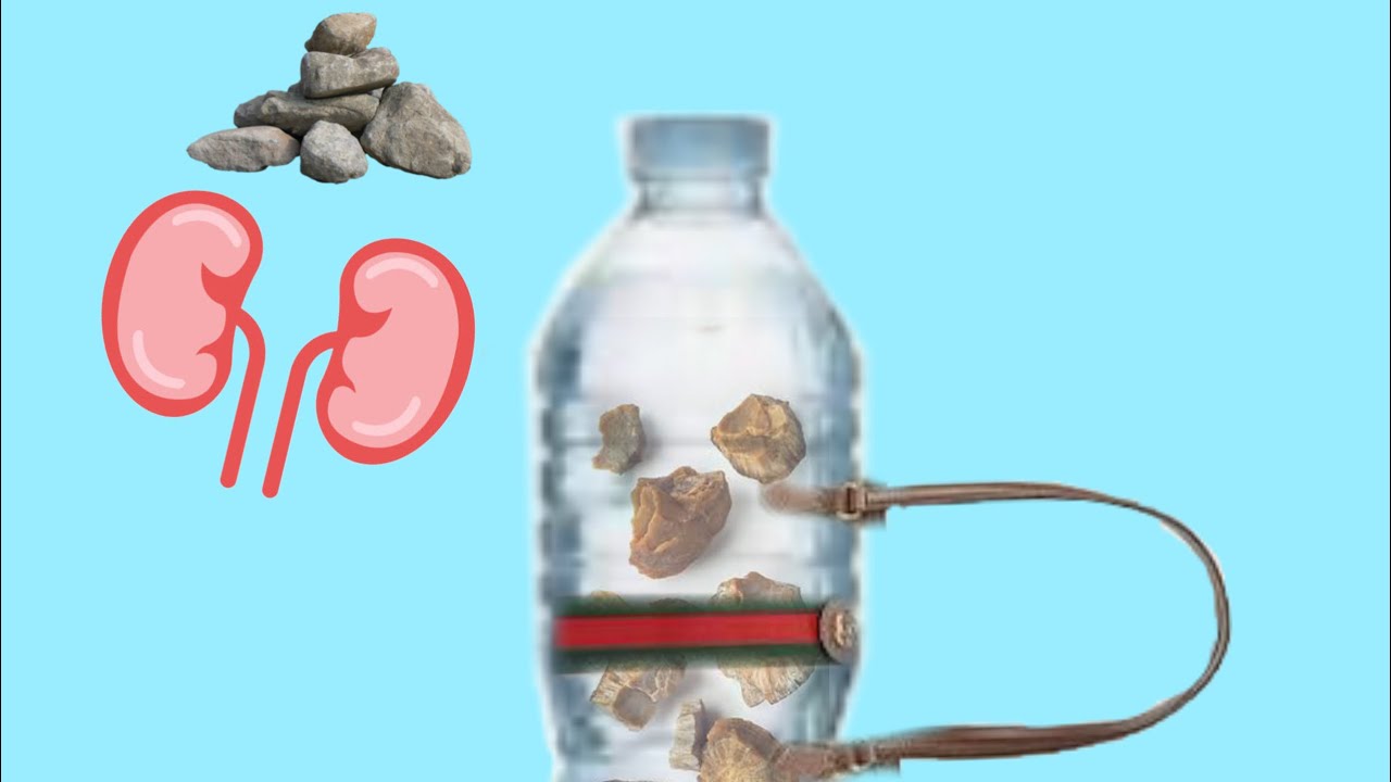 Kidney Stones In A Plastic Water Bottle. - YouTube