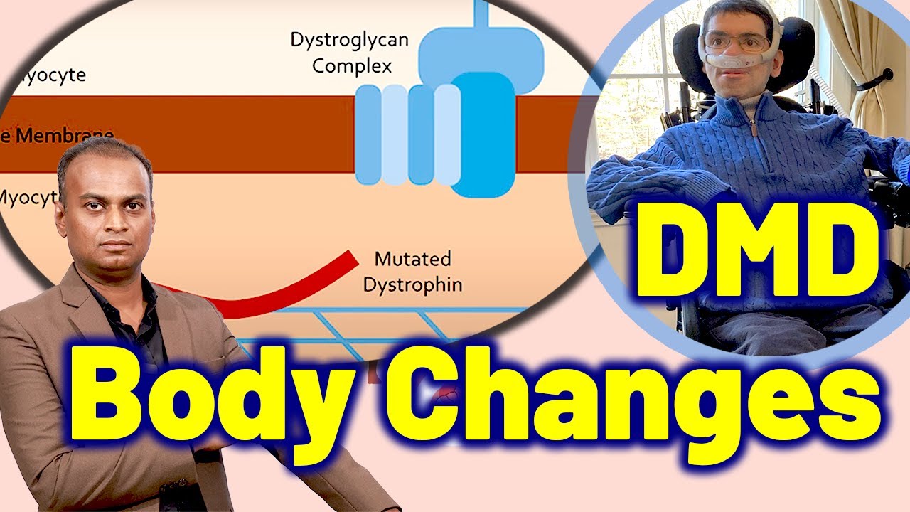 Changes in the body due to Duchenne Muscular Dystrophy DMD | Treatment ...