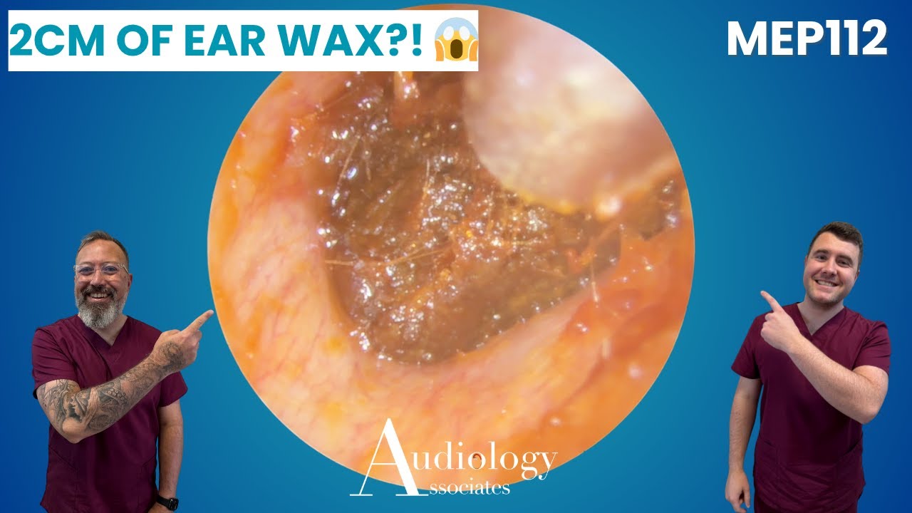 Dead Skin, Sticky Ear Wax & Satisfying Suction! - MEP112 - YouTube