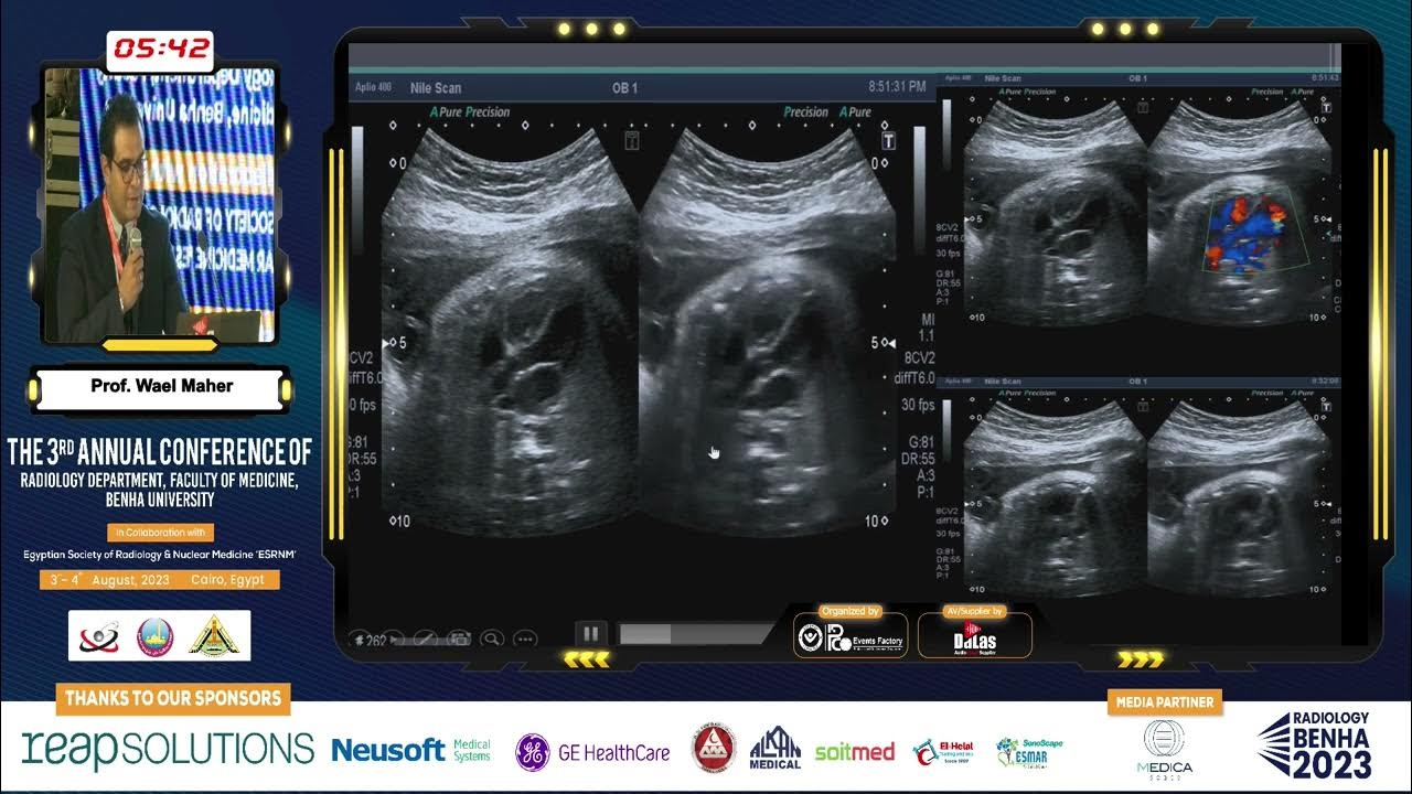 Basics of Fetal Echocardiography - YouTube Basics of Fetal Echocardiography - YouTube