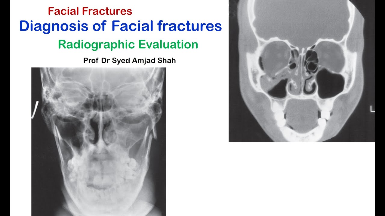 Diagnosis of Facial Fractures | Radiographic Evaluation | Syed Amjad ...