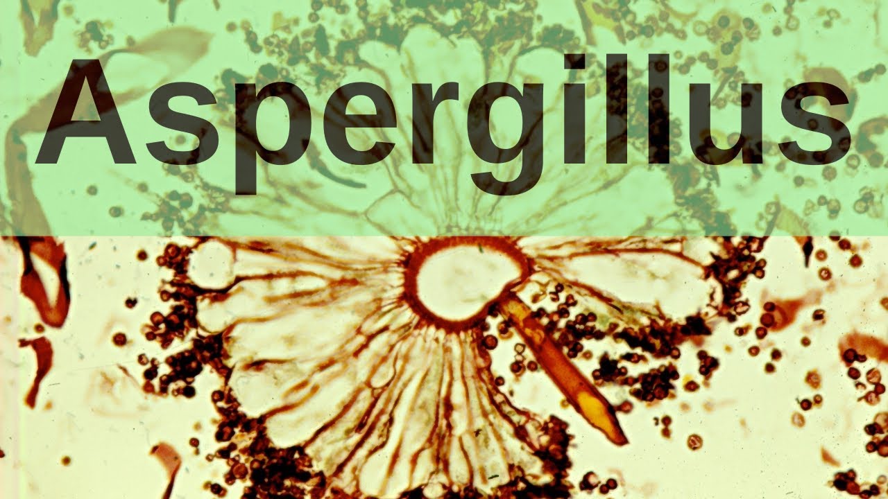 Aspergillus and Aspergillosis - Pathology mini tutorial - YouTube