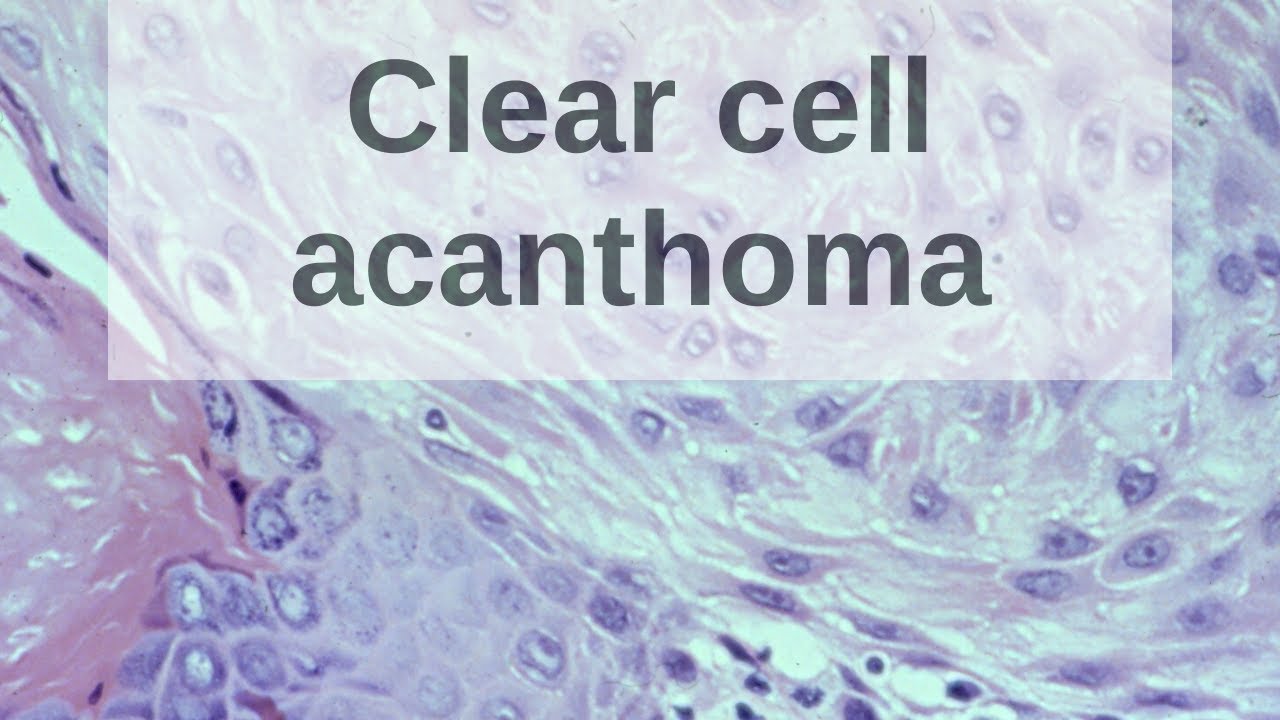 Clear Cell Acanthoma - Pathology mini tutorial - YouTube