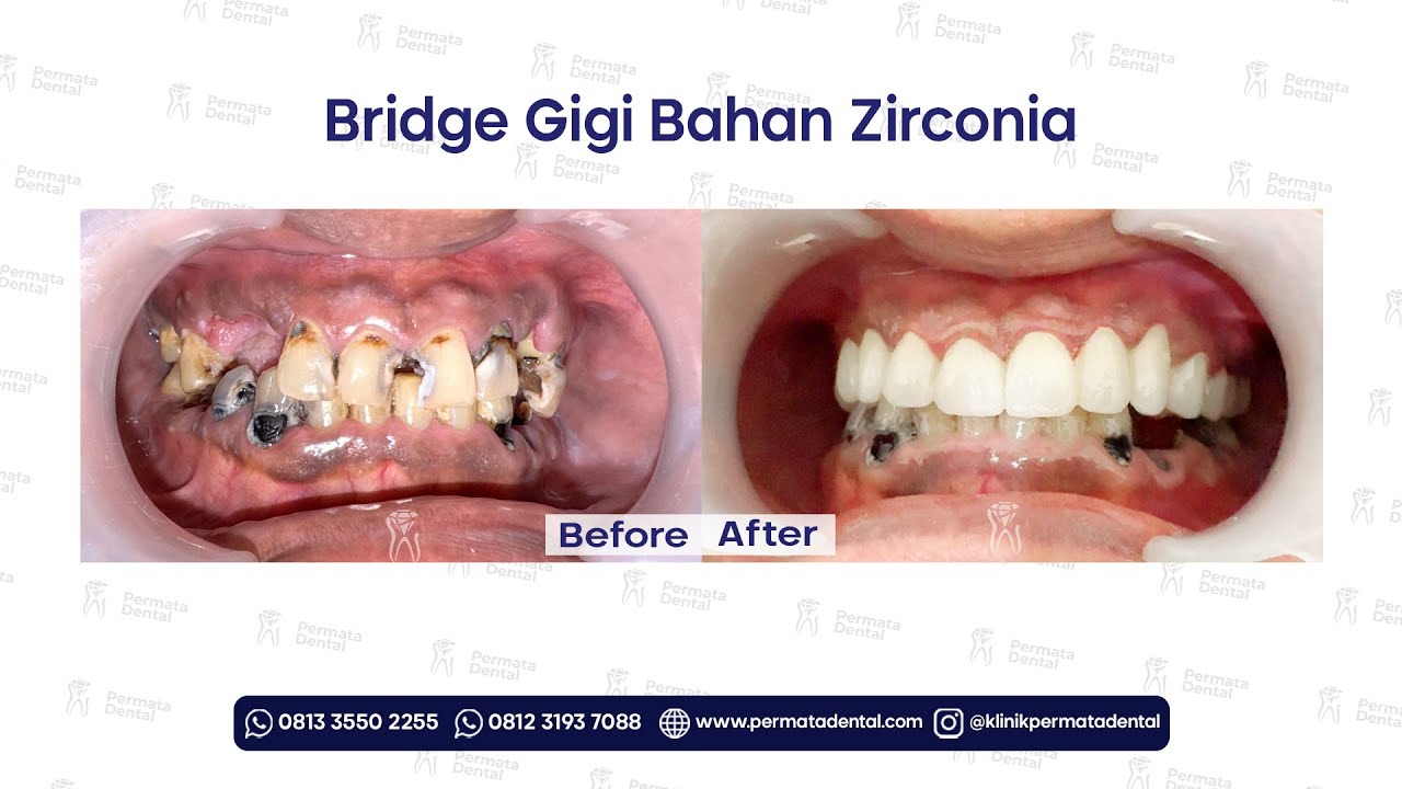 Proses Pembuatan & Pemasangan Bridge Gigi Berbahan Zirconia di Permata ...