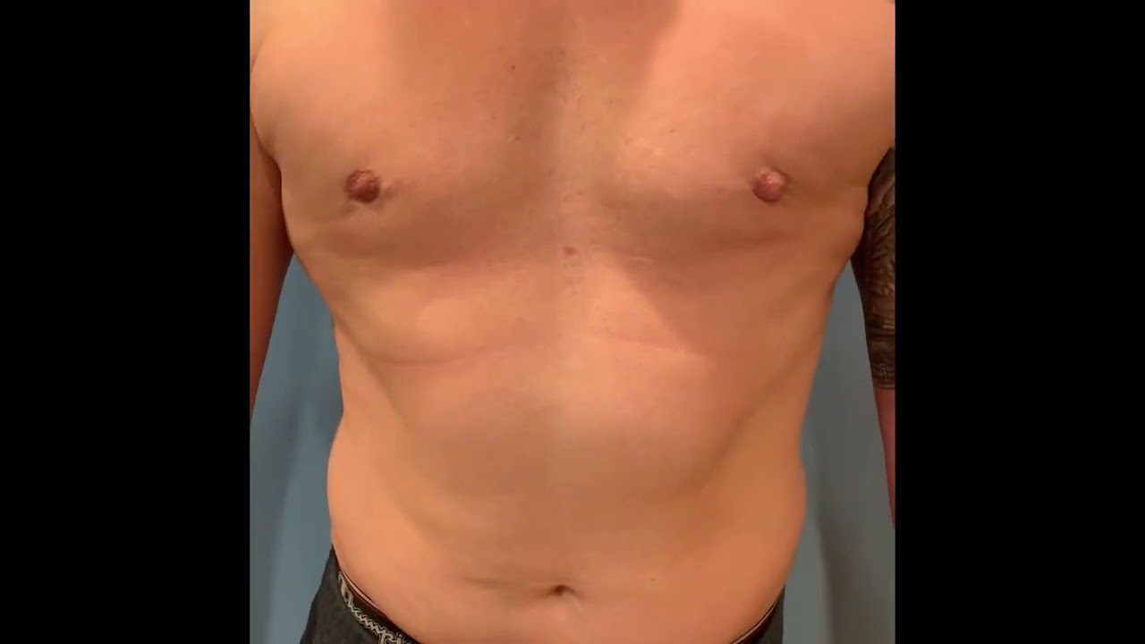 Fixing BOTCHED Gynecomastia NEW YORK Male: Vaser HI-DEF LIPO, 6-Pack ...