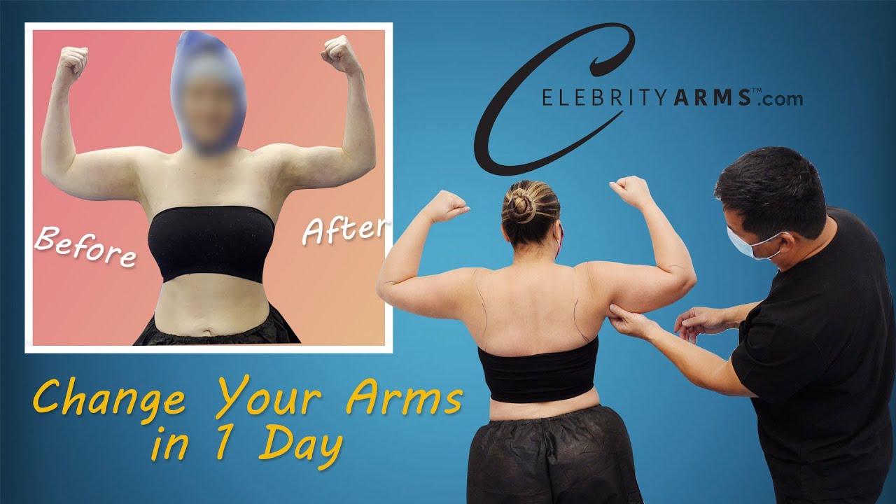 Arm Liposuction Immediate Results| Celebrity Arms™ High Definition Lipo ...