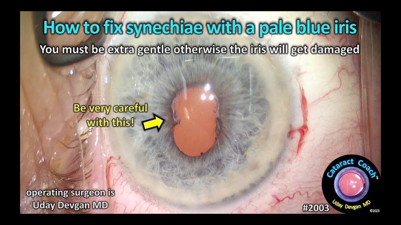 CataractCoach™ 2003: how to fix synechiae with a pale blue iris - YouTube
