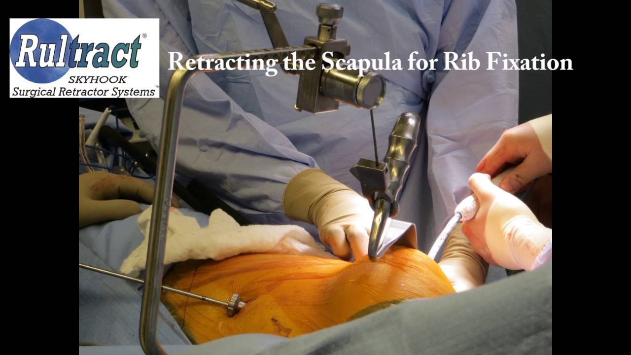 Rultract Retract Scapula Rib Fixation 7 22 16 using Zimmer Biomet ...