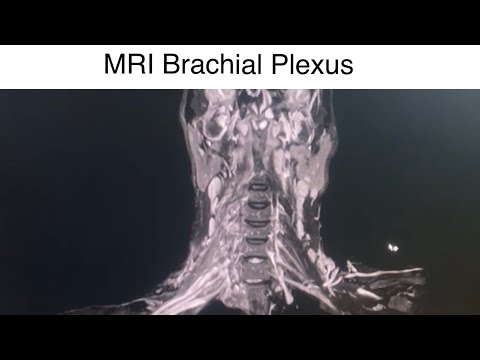 MRI Brachial Plexus ( Space T2 STIR Coronal) RT. Plexuses Roots Injury ...