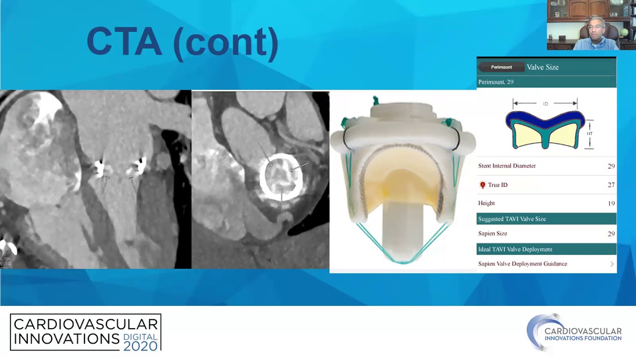 A challenge I beat in the last year - Ashish Pershad, MD - YouTube