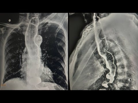 Corkscrew Esophagus: Distal Esophageal Spasm - YouTube