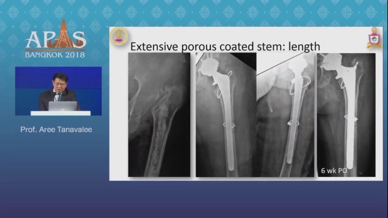 Management of Femoral Bone Loss - How I Do It - Prof. Aree Tanavalee ...