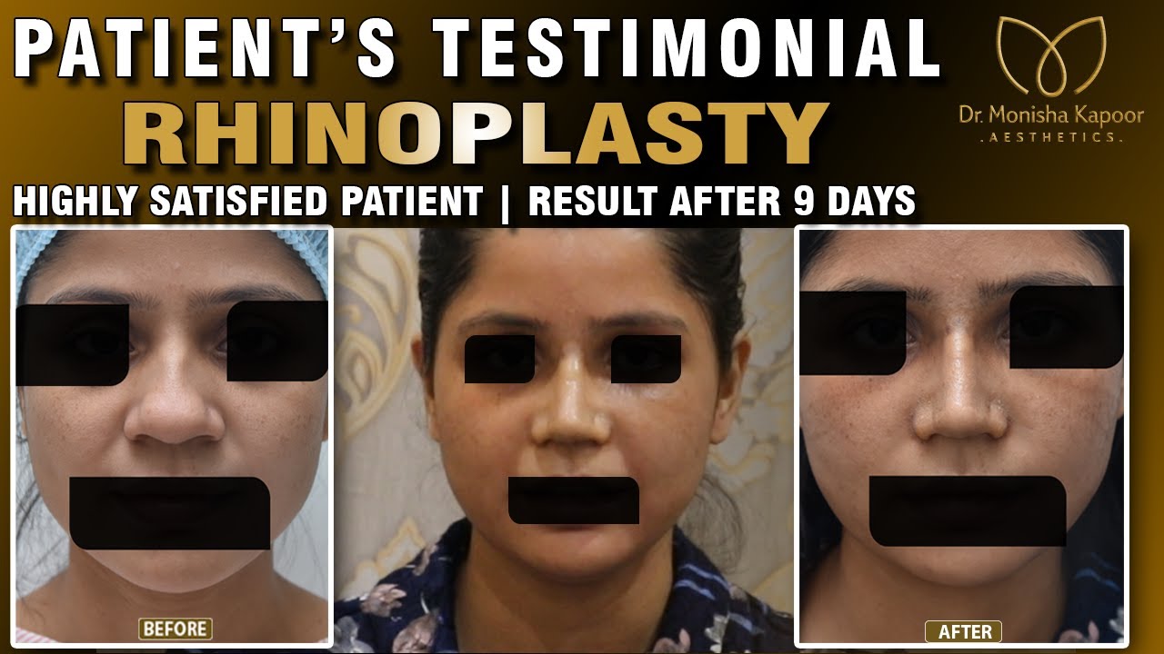 Rhinoplasty in India| Nose job Surgery by Dr. Monisha Kapoor| Happy ...